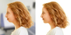 Génioplastie - Chirurgie du menton - Menton en avant, menton fuyant ...