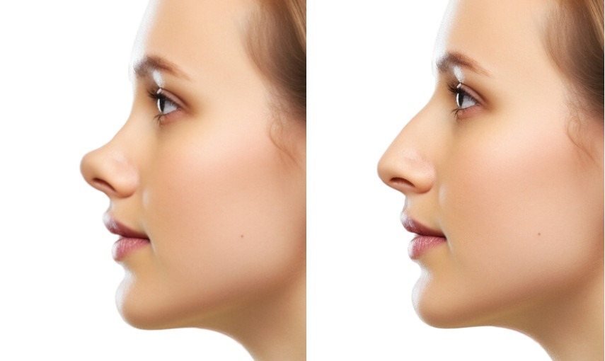 Rhinoplastie - Nez en trompette (retroussé)