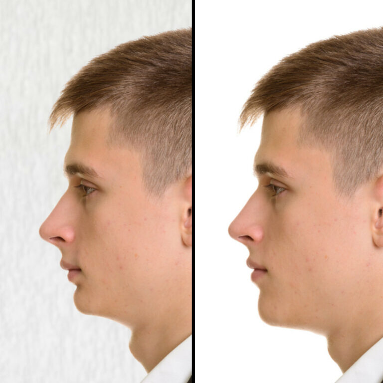 Simulation - Classe II squelettique - Chirurgie-avant-apres.fr