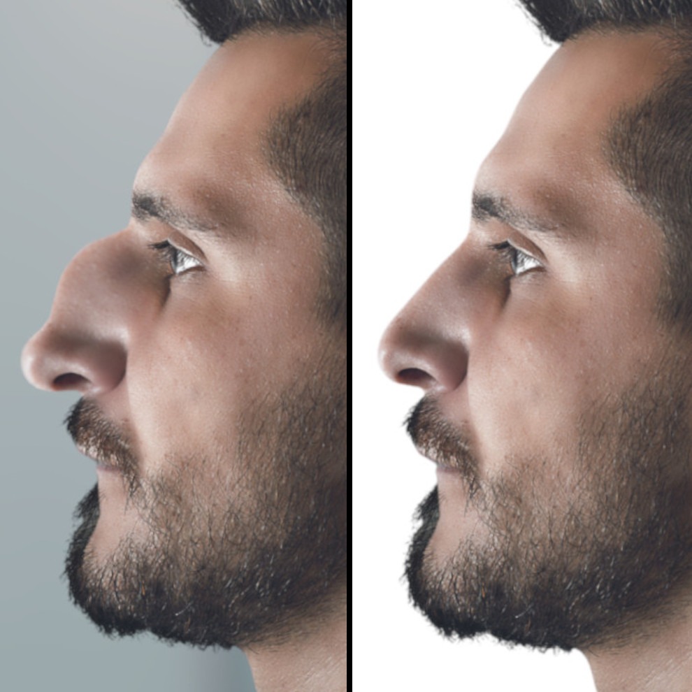 Simulation - Rhinoplastie - Nez - Chirurgie Avant Après
