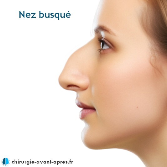 Simulation - Rhinoplastie - Nez - Chirurgie Avant Après