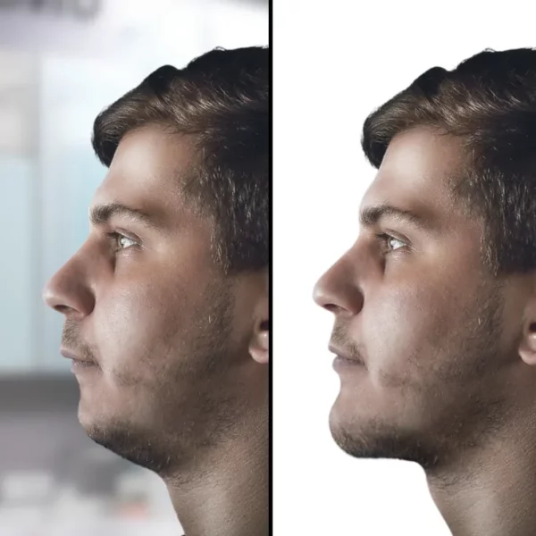 Simulation - Mâchoire en arrière - Chirurgie Avant Après