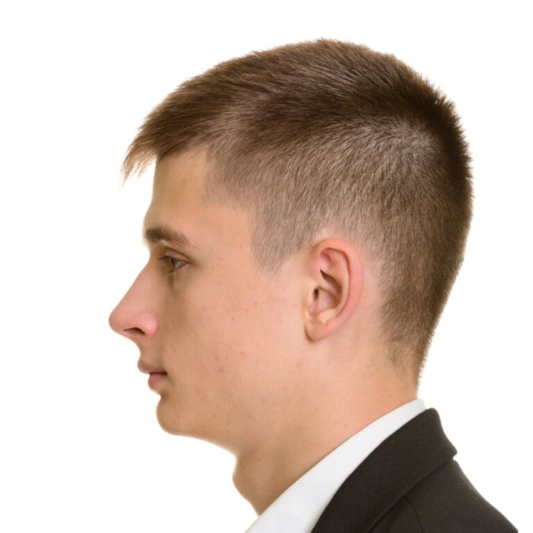 Solutions pour corriger un menton fuyant - Chirurgie Avant Après