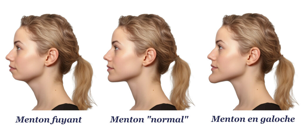 Quels sont les 3 profils de menton ? - Chirurgie-avant-apres.fr