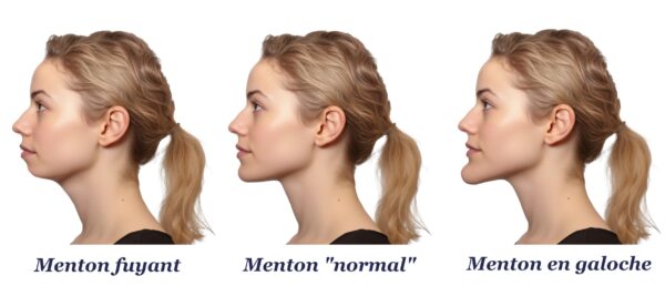 Quels sont les 3 profils de menton ? - Chirurgie-avant-apres.fr