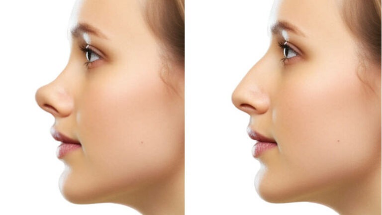 Rhinoplastie - Nez en trompette (retroussé)