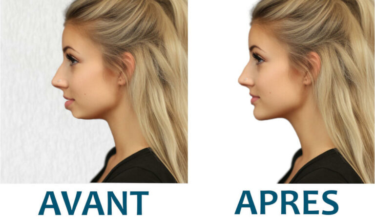 Solutions pour corriger un menton fuyant - Chirurgie Avant Après