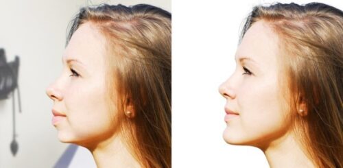 Solutions pour corriger un menton fuyant - Chirurgie Avant Après