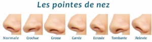 Rhinoplastie de la pointe du nez