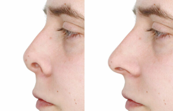 Photos avant après une rhinoplastie