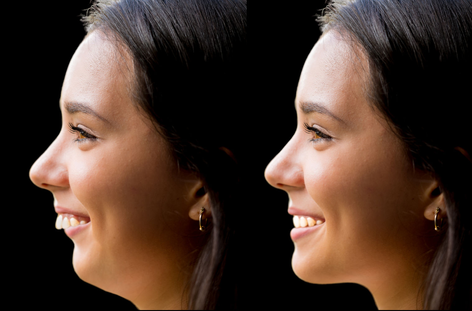 Dents en avant et menton rentré