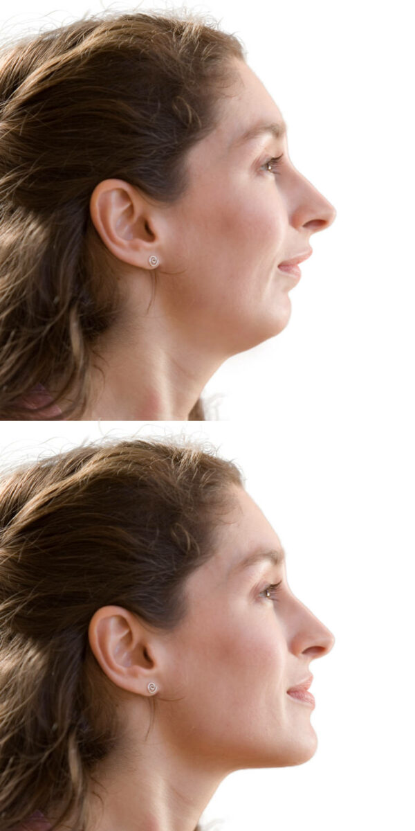 Simulation d'avancée du menton et de la mâchoire inférieure